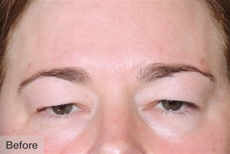 Blepharoplasty Before And After Photos Dr Rodger Davies