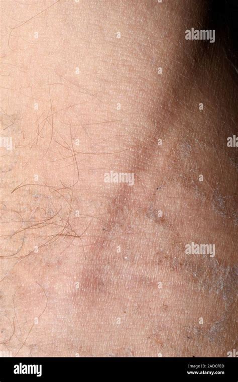 Thrombosed Vein After Cannulation Close Up Of The Skin Of A 35 Year Old Male Patient With A