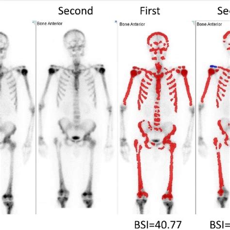 The Patient With The Largest Difference In Bsi At The Two Different Download Scientific Diagram