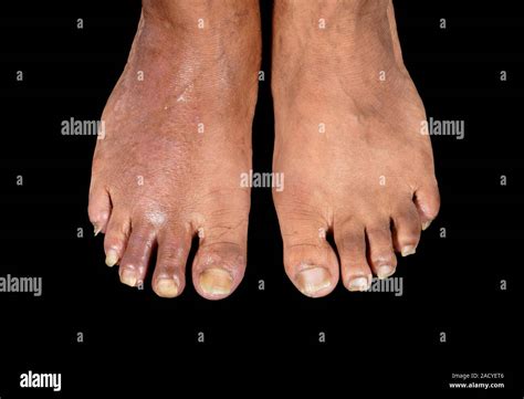 Psoriatic Arthritis On A Patients Feet Psoriatic Arthritis Occurs In