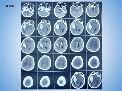 Endovascular Coil Embolization Of Dissecting Distal Mca Aneurysm With Ich In Paediatrics Age