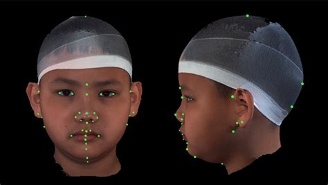 Figure 1 From Occlusion Based Three Dimensional Craniofacial Anthropometric And Symmetric