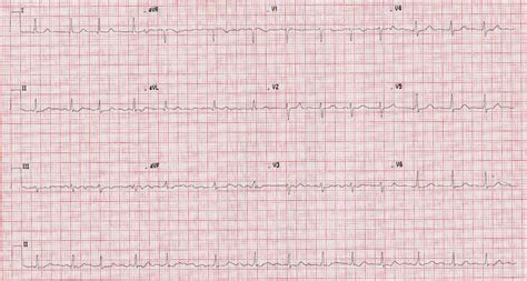 Shows The Effect Of Synchronized Hfs Identifying An Et Gp Near The Left Download Scientific