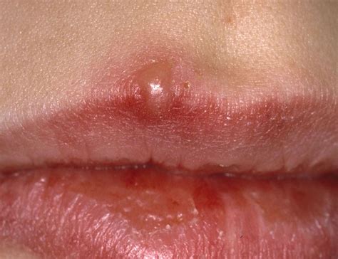 Hpv White Spots On Lips Infoupdate Org
