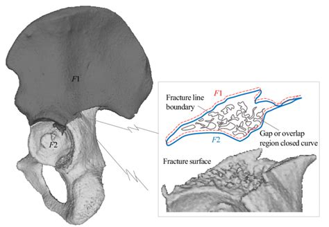 Illustration Of Recovered Bone And Mesh Defects On The Surface Contact Download Scientific