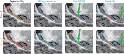 Multi Scale Hippocampal Parcellation Improves Atlas Based Segmentation Accuracy Medical Image