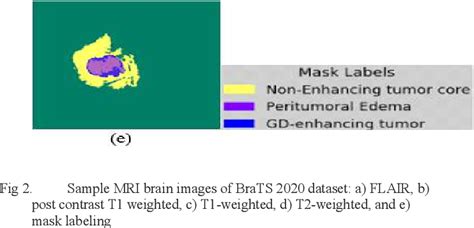 Figure 2 From Effective Mri Based Brain Tumor Detection Using Modified