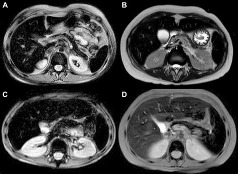 Abdominal Mri T2 Ffe Fast Field Echo Sequences Show Hypointense