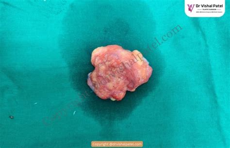 10 Real Lipoma Removal Pictures Stomach Neck Hand Photos