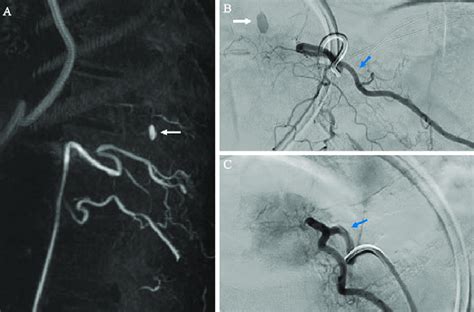 A Spinal Angiogram Multiframe Spin Image Demonstrating Filling Of Download Scientific Diagram