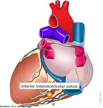 Inferior Interventricular Sulcus E Anatomy Imaios