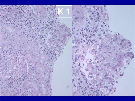 Ppt C4d Staining And Morphology In Protocol Biopsies Powerpoint