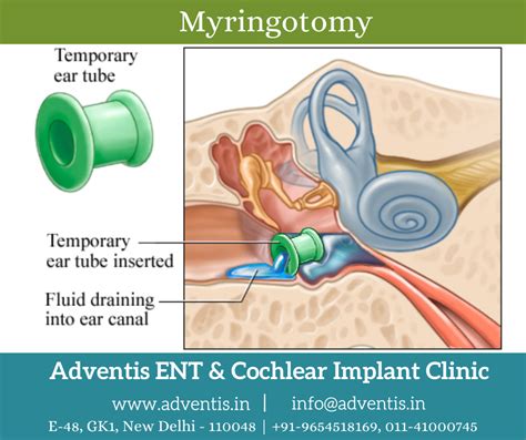 History Of Myringotomy Tubes Icd 10 Design Talk