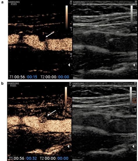 A Ceus Shows A Carotid Stenosis Degree About 50 At The Left Internal