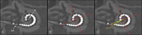 Angular Electrode Insertion Depth And Speech Perception In A