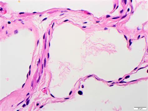 Lymphangioma Histology