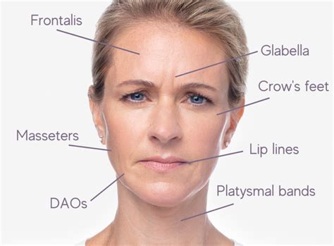 Your Cosmetic Injection Site Cheat Sheet Radiance Skincare And Laser Medspa