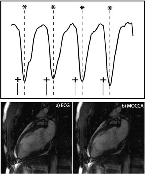Representative Cardiac Self Gating Signal Derived Using Mocca And