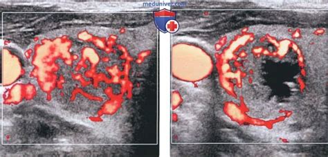 УЗИ при медуллярном раке щитовидной железы