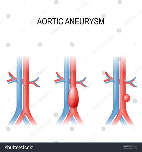 Types Abdominal Aortic Aneurysm Normal Aorta Stock Vector Royalty Free