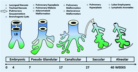 Pulmonary Sequestration A 29 Patient Case Series And Review
