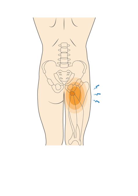 Ischial Bursitis Artofit