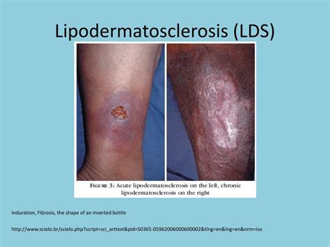 Ppt Venous Insufficiency Powerpoint Presentation Free Download Id 3377807