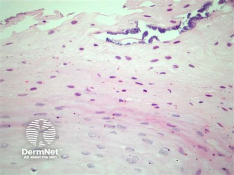Hairy Leukoplakia Histology Oral Proliferative Verrucous Leukoplakia