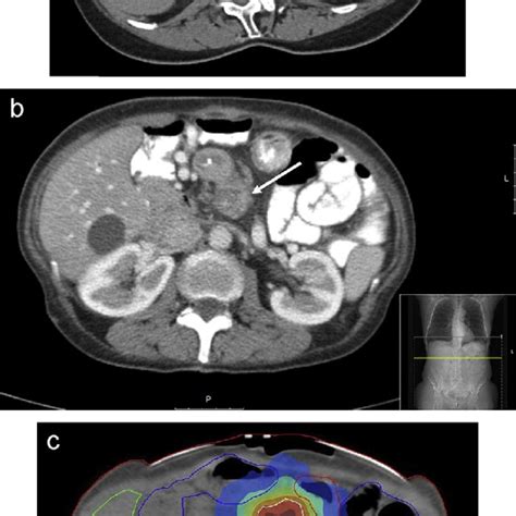 A Transversal Ct Imaging Showing Resectable Isolated Local Recurrence