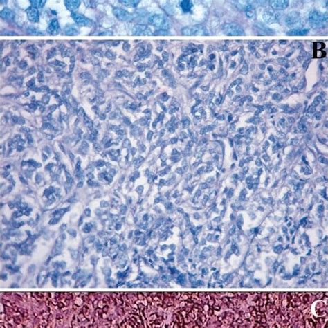 Histopathology Of Primitive Neuroectodermal Tumor Showing A Sheets