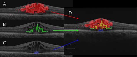 The Three Individual Dme Detections And The Final Merged Pathological Download Scientific