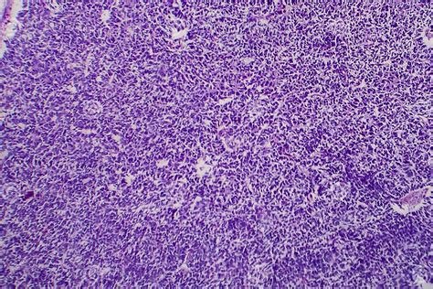Wilms Tumor Light Micrograph Stock Image Image Of Neoplasia Pathology 161613411