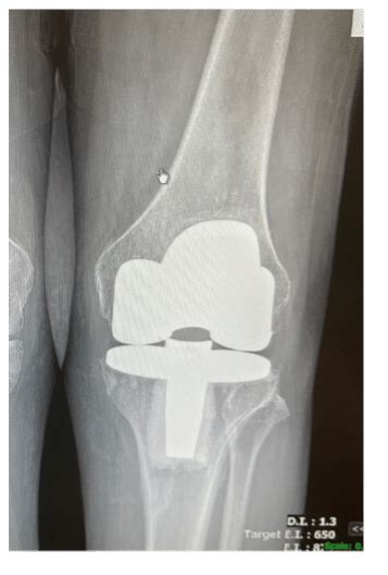 Case Study Use Of Portable Precision Alignment Orthalign