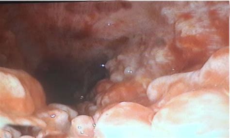 Tracheal Mucosa As Seen During The Fibroptic Bronchoscopy Multiple Red Download Scientific