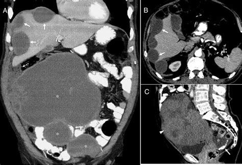 Imaging Findings For Mucinous Tumors Tumortumorof The Abdomen And