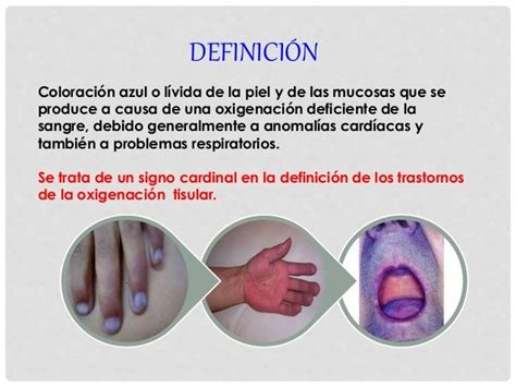 Cianosis