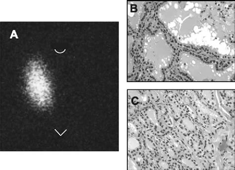 Figure 1 From A Somatic Gain Of Function Mutation In The Thyrotropin