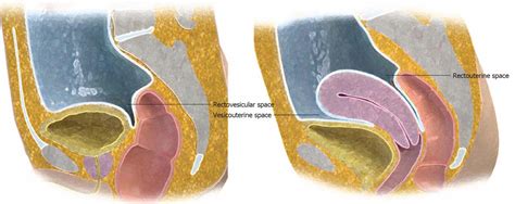 Patterns Of Peritoneal Spread Of Tumor In The Abdomen And Pelvis