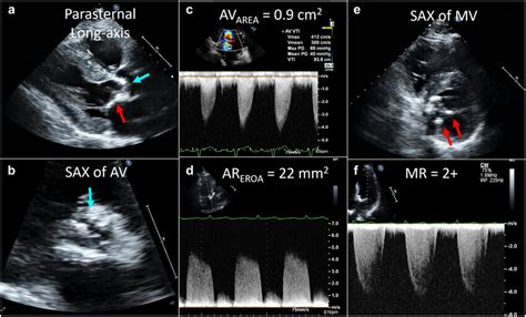 Transthoracic Echocardiography In Radiation Valvular Disease The