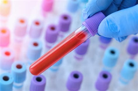 Tangan Dengan Sarung Tangan Medis Dokter Memegang Tabung Reaksi Dengan Sampel Darah Di Latar