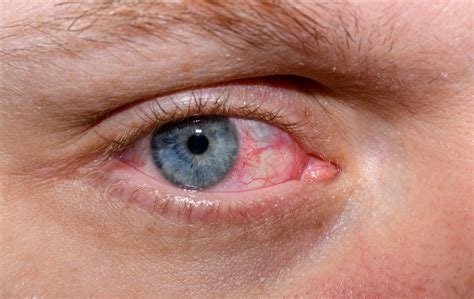 Dry Eye Disease Symptoms And Treatment Anderson Eye Care