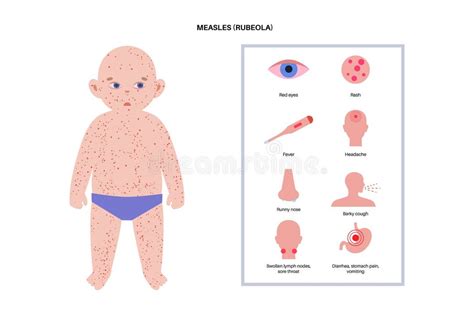 Measles Or Rubeola Symptoms Stock Vector Illustration Of Rash