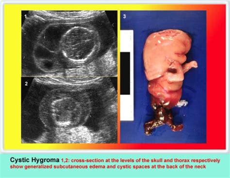 Cystic Hygroma Department Of Obstetrics And Gynecology Faculty Of