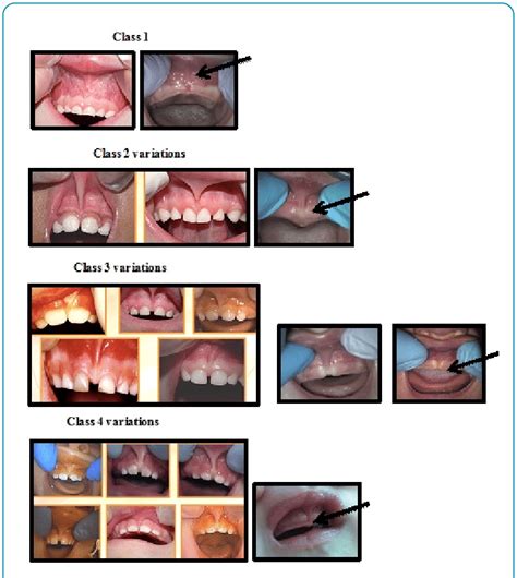 Lawrence L Kotlow Upper Lip Tie Classifications Download Scientific Diagram