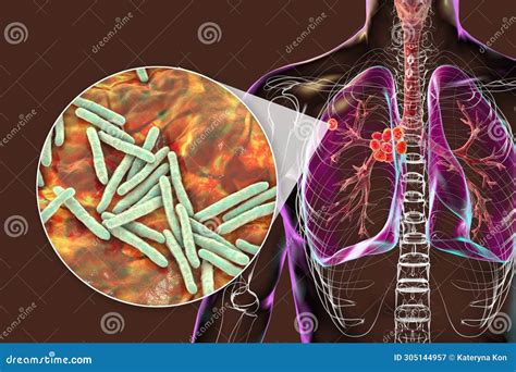 Primary Lung Tuberculosis 3d Illustration Stock Illustration Illustration Of Progress Ghon