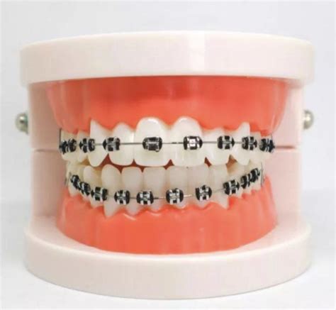 Malaysia Stock Perhiasan Gigi Clip Normal Design Braces Lazada