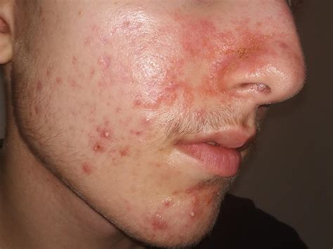 Why This Sudden Dermatitis And Acne Breakout R Dermatology