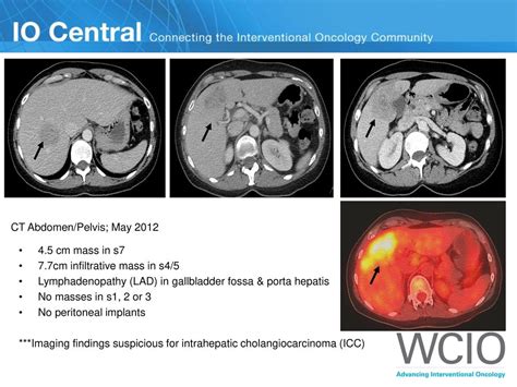 Multi Modality Approach To Managing Intrahepatic Cholangiocarcinoma Ppt Download