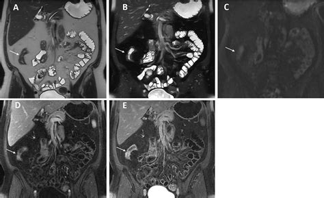 Sar Consensus Recommendations For Defining Small Bowel Crohn Disease