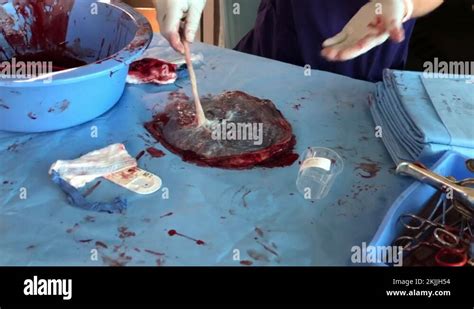 After Birth Placenta Videos